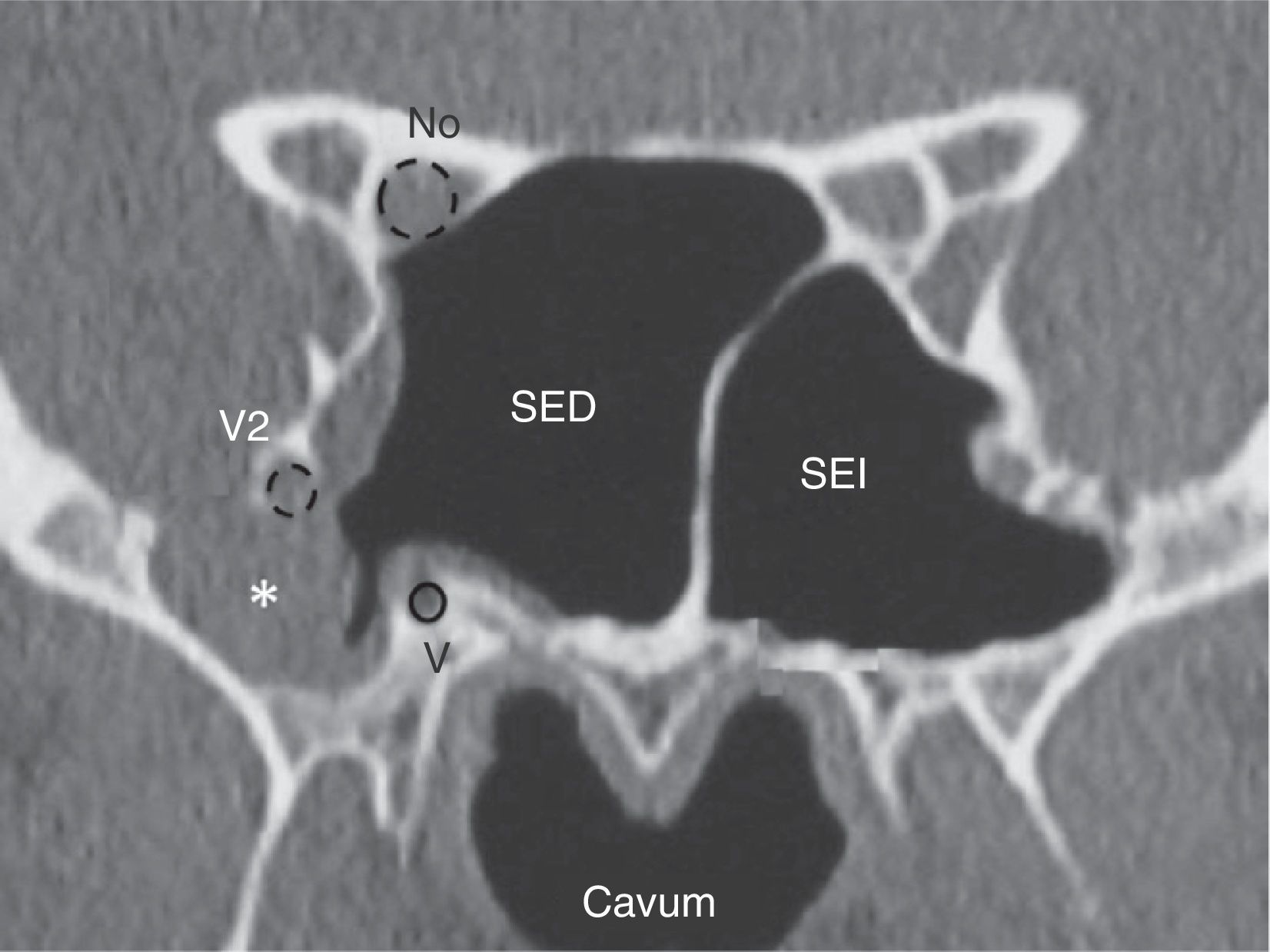 Endoscopic Transpterygoid Approach and Skull Base Repair After Sphenoid ...