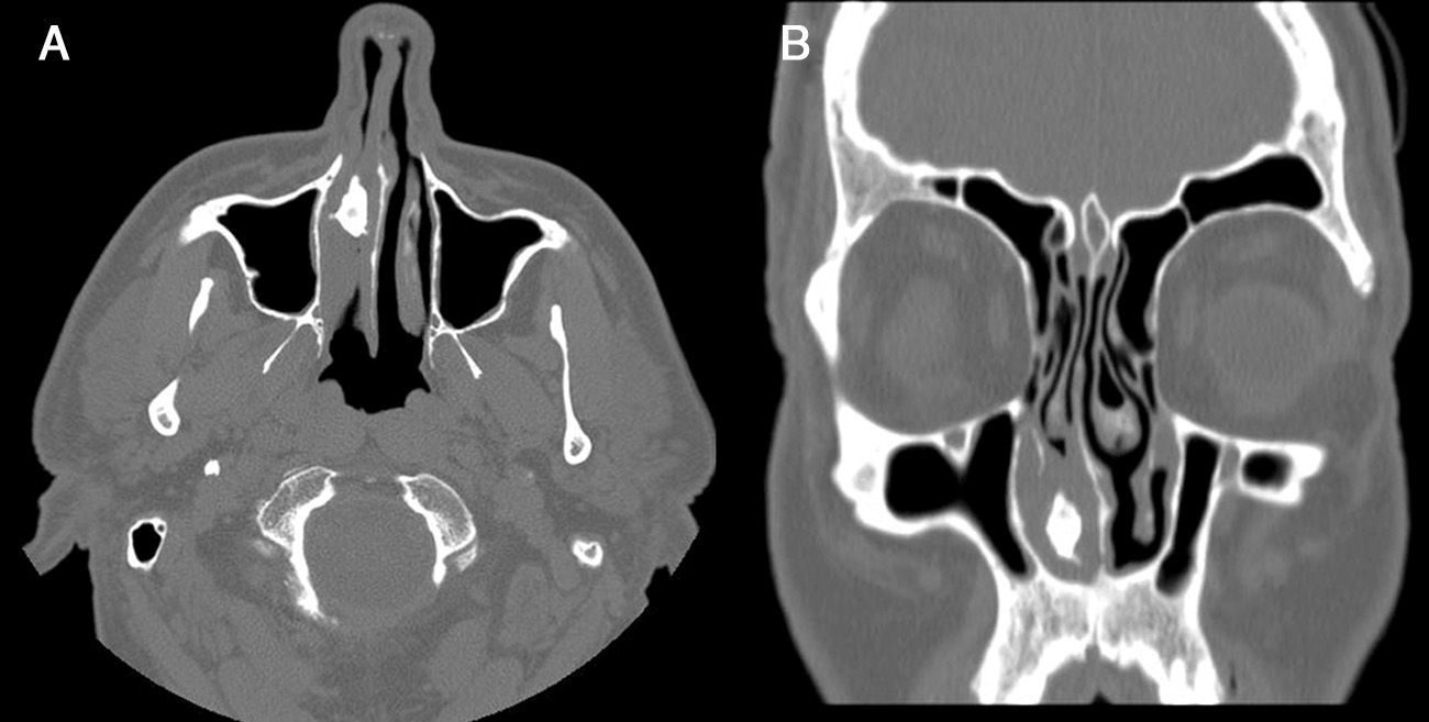 Rhinolith in Right Nasal Cavity | Acta Otorrinolaringológica Española