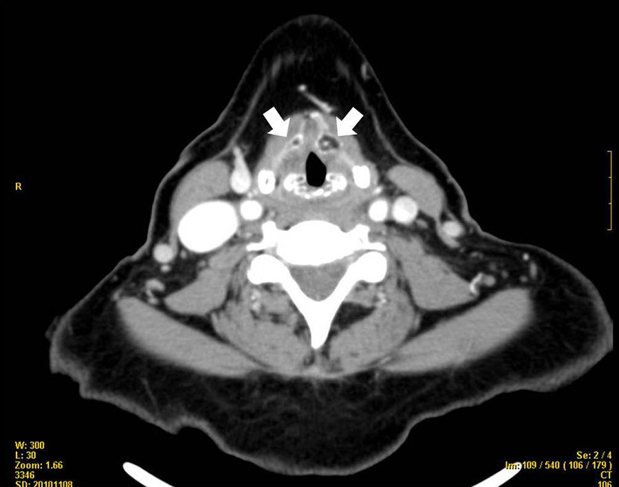 Bilateral Dystrophic Ossification of the Thyroid Cartilage | Acta ...