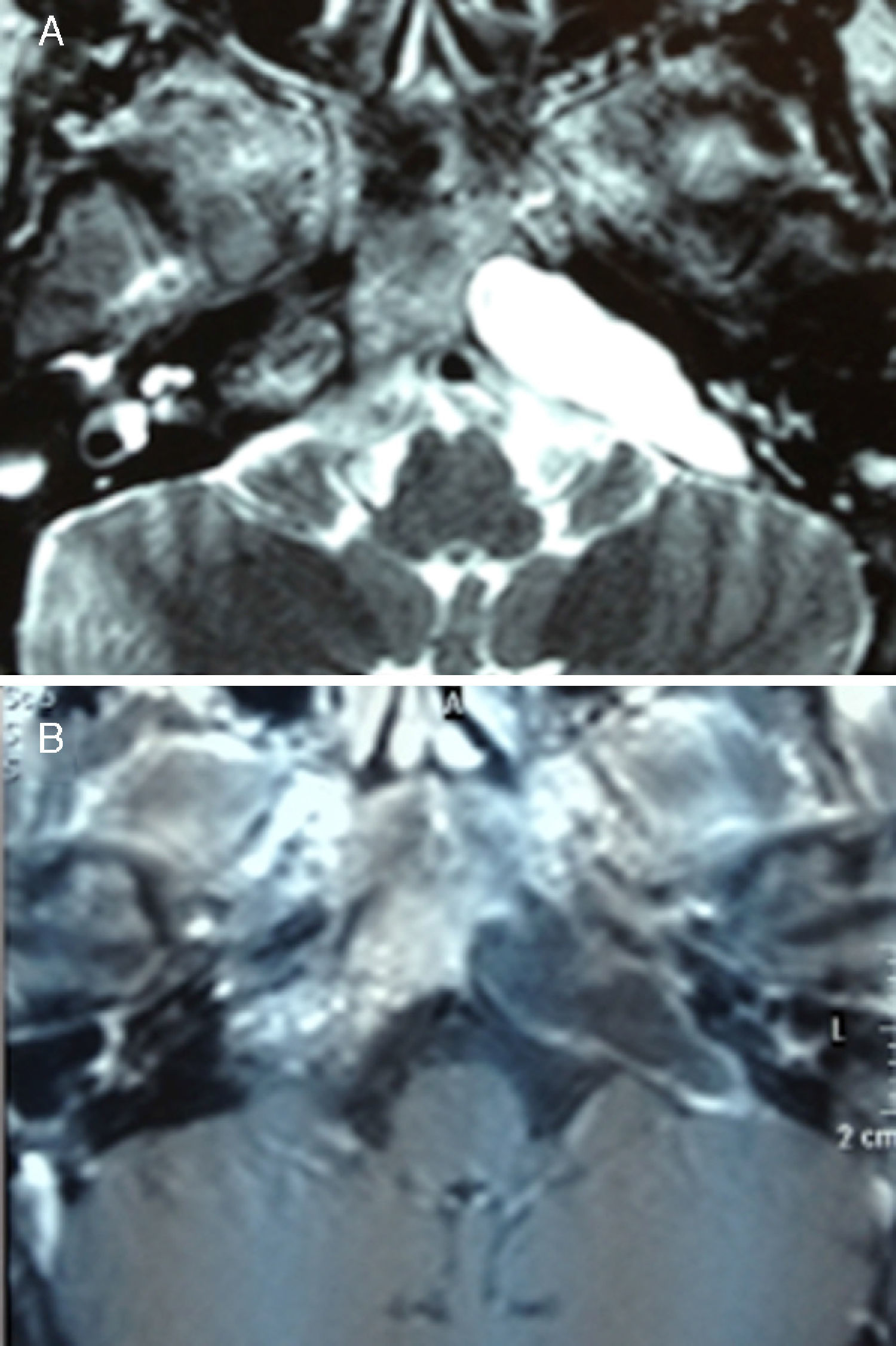 Middle Fossa Approach: Applications in Temporal Bone Lesions | Acta ...