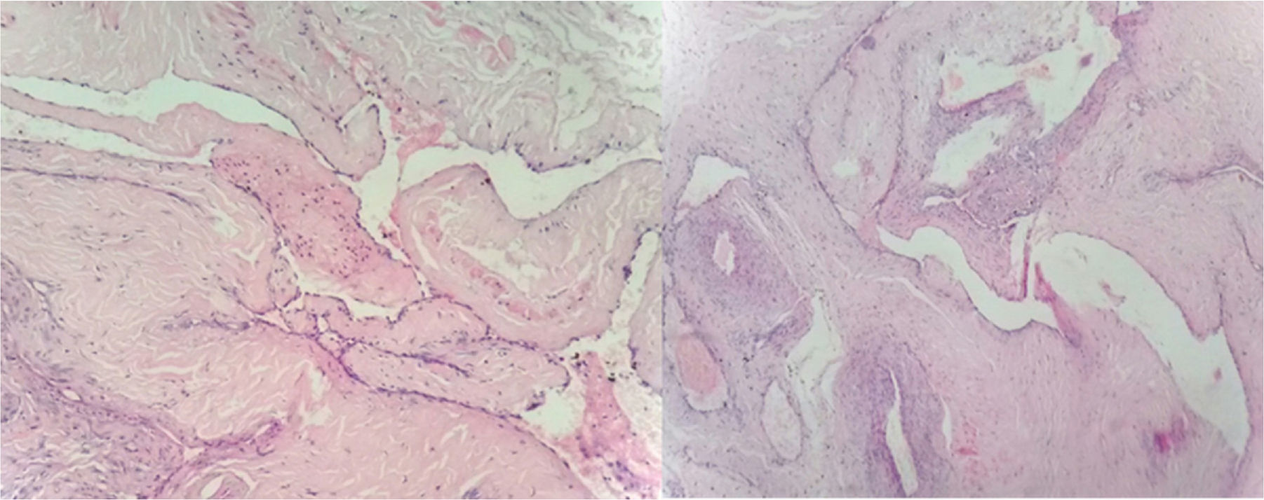 Venous malformation of right angular vein | Acta Otorrinolaringológica ...