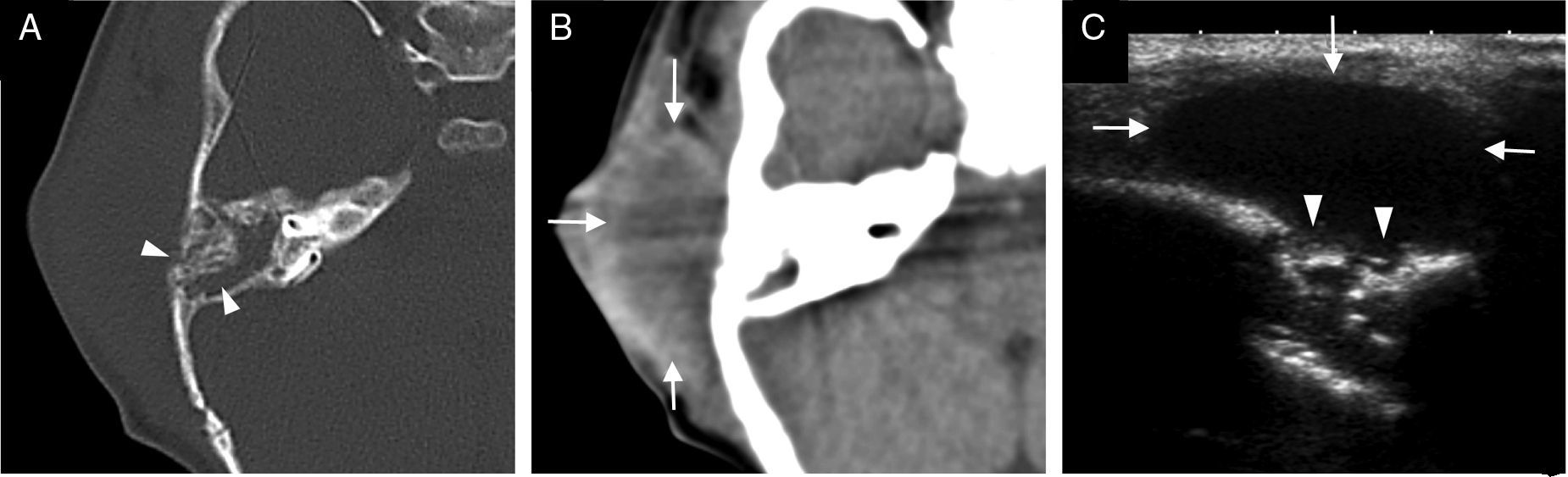 Indications and Radiological Findings of Acute Otitis Media and Its ...