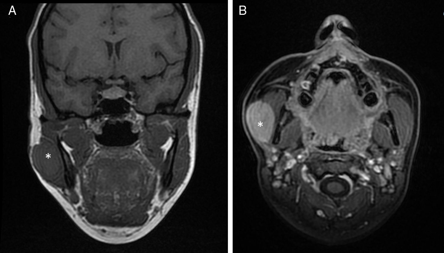 Granular Cell Tumour in the Masseter Muscle | Acta ...