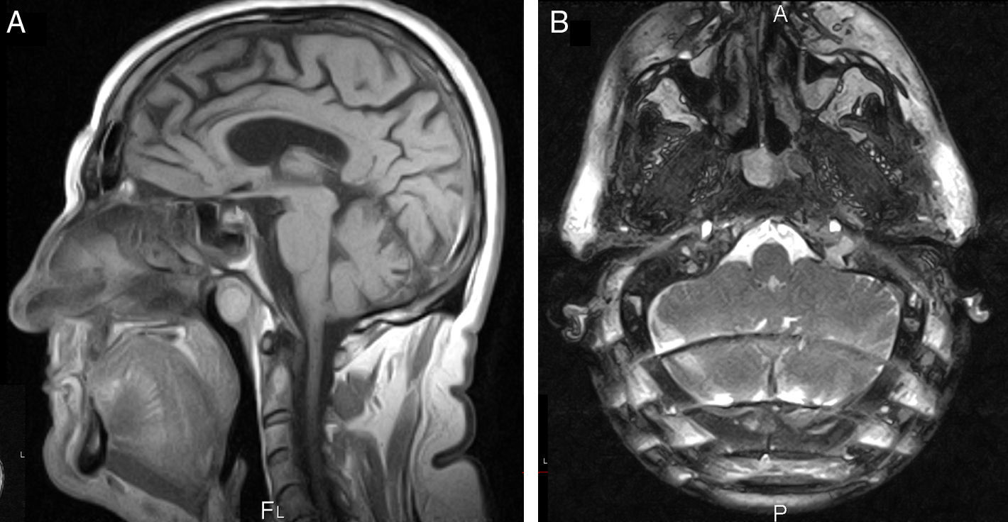 Nasopharyngeal Oncocytoma as a Cause of Eustachian Tube Dysfunction ...