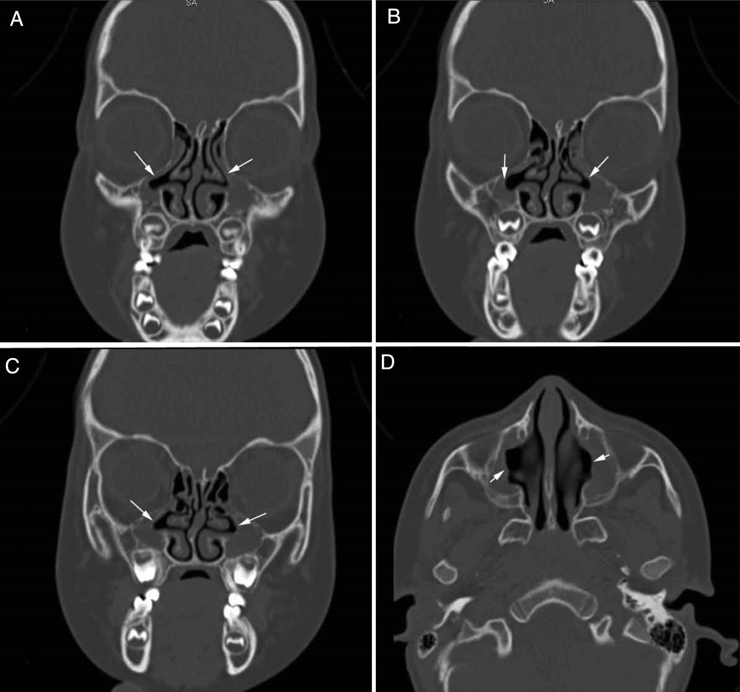 Spontaneous Resolution of Chronic Maxillary Atelectasis in a Paediatric ...