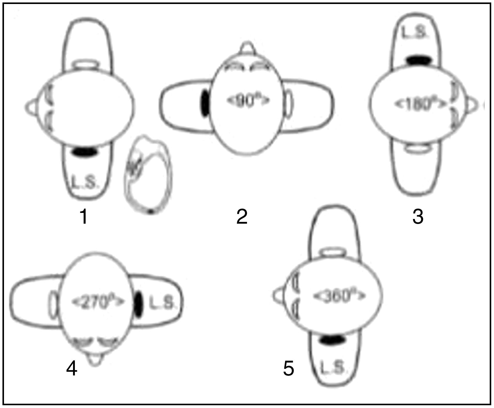 Efficacy of Particle Repositioning Manoeuvres in Benign Positional ...