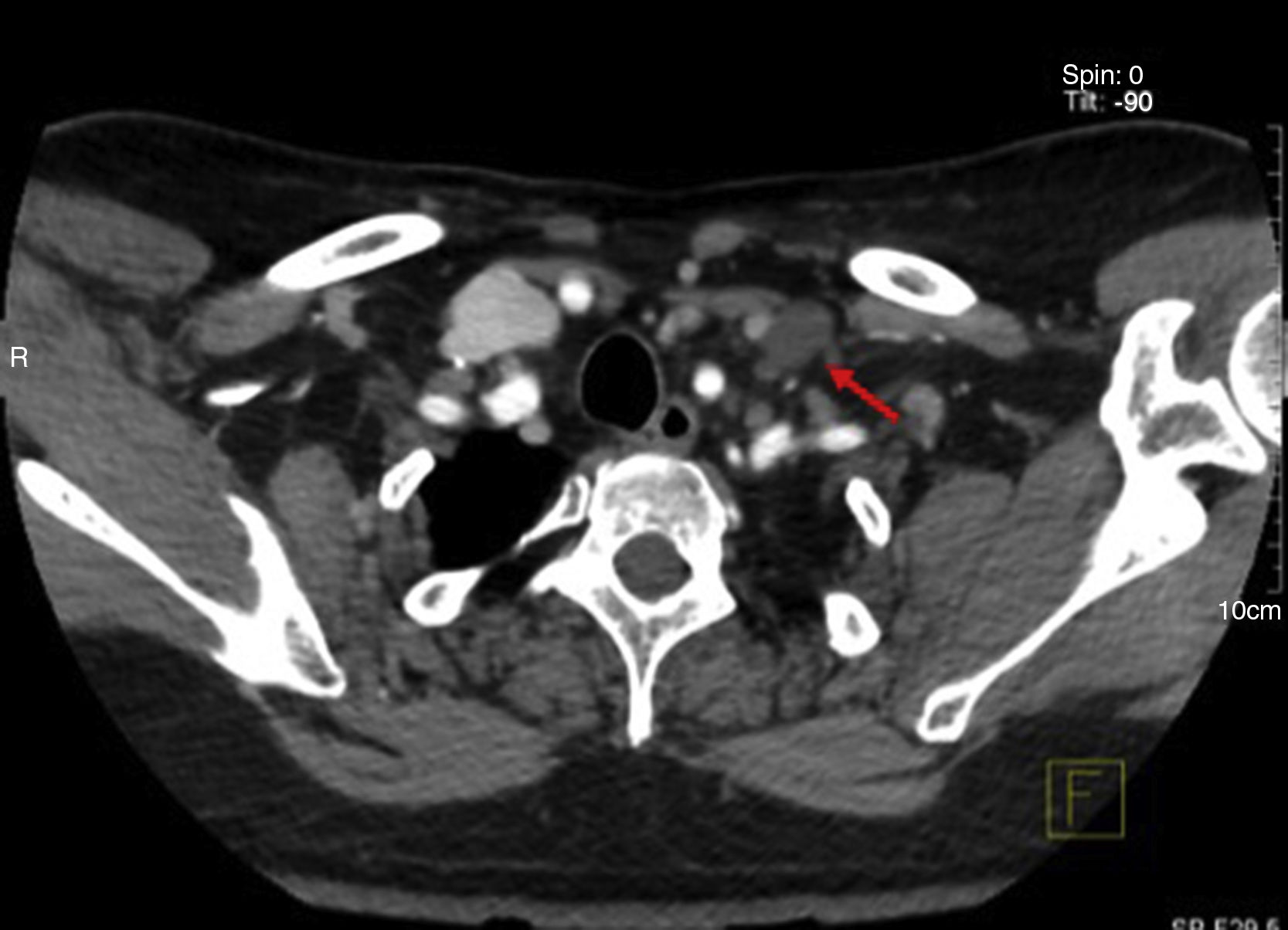 Thoracic Superior Duct Cyst: An Incidental Finding | Acta ...