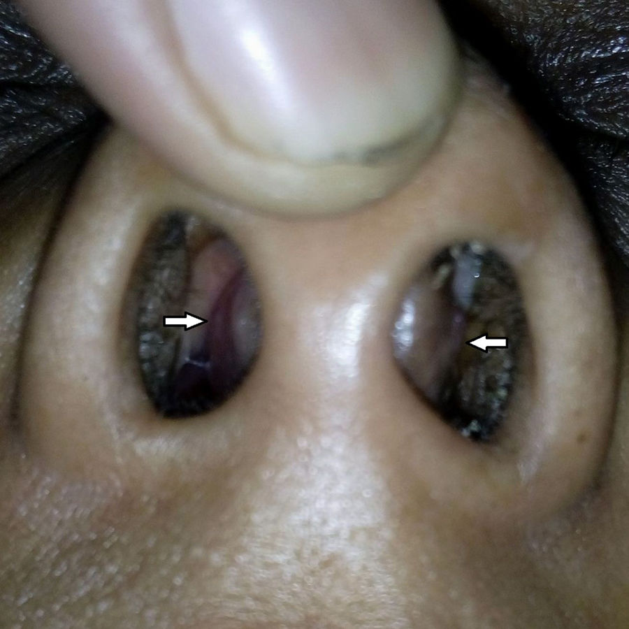 Primary tuberculosis of the nasal septum: The non-ulcerated form ...