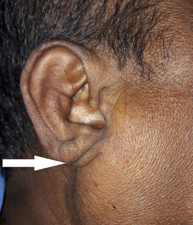 Frank's Sign | Acta Otorrinolaringológica Española