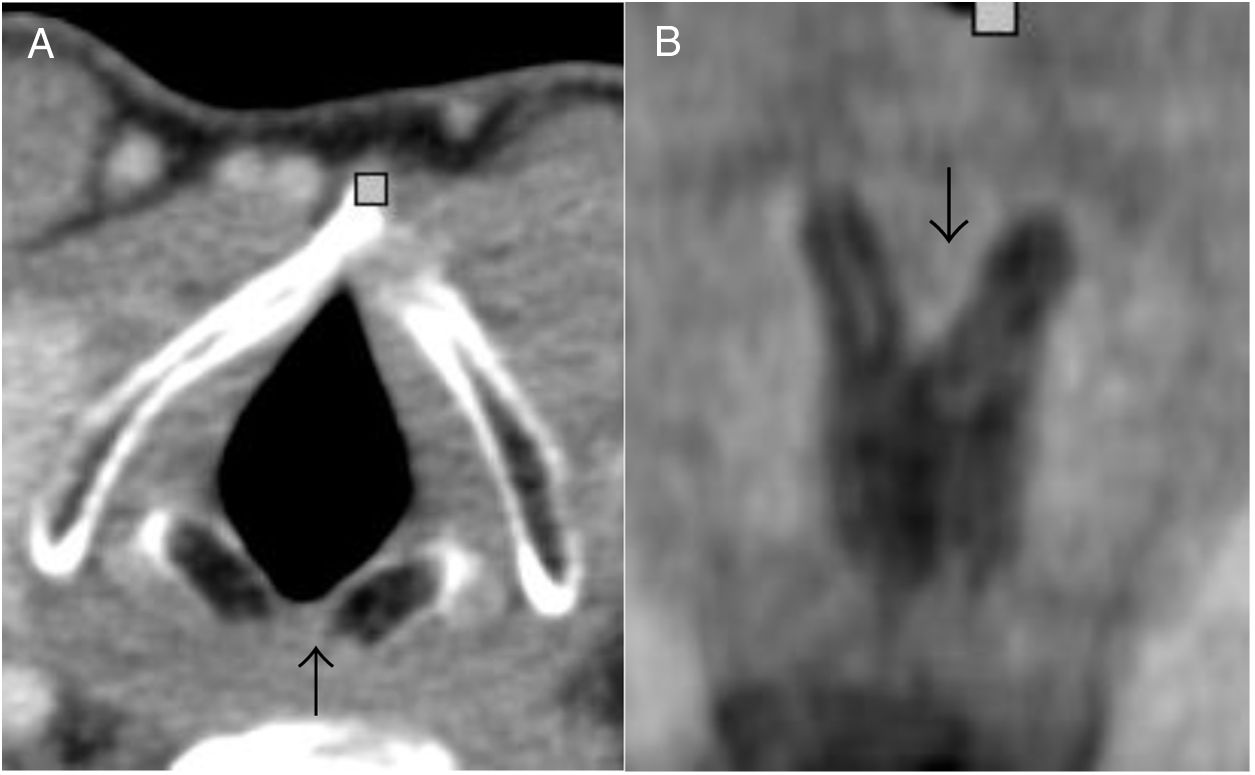 Laryngeal Cleft: Diagnosis and Treatment of an Unusual Presentation in ...
