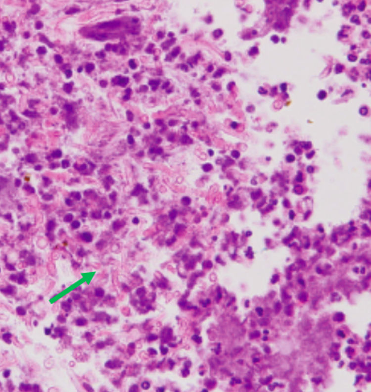 Candida albicans causing cervical pyomyositis: A case report | Acta ...