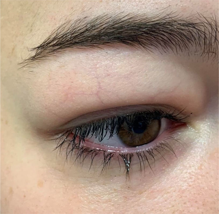 Spontaneous Subcutaneous Orbital Emphysema | Acta Otorrinolaringológica ...