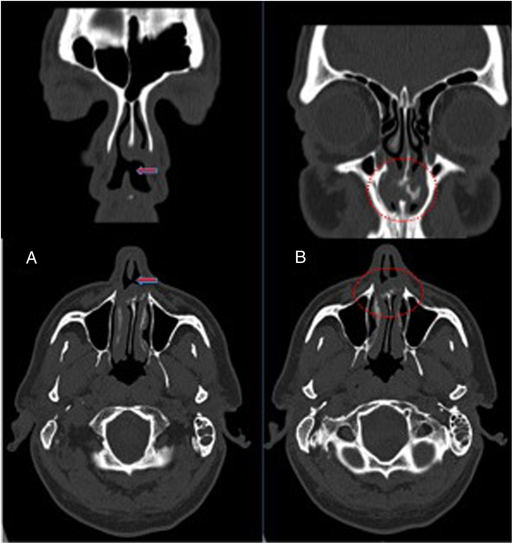 Giant Cell Granuloma of Nasal Septum | Acta Otorrinolaringológica Española