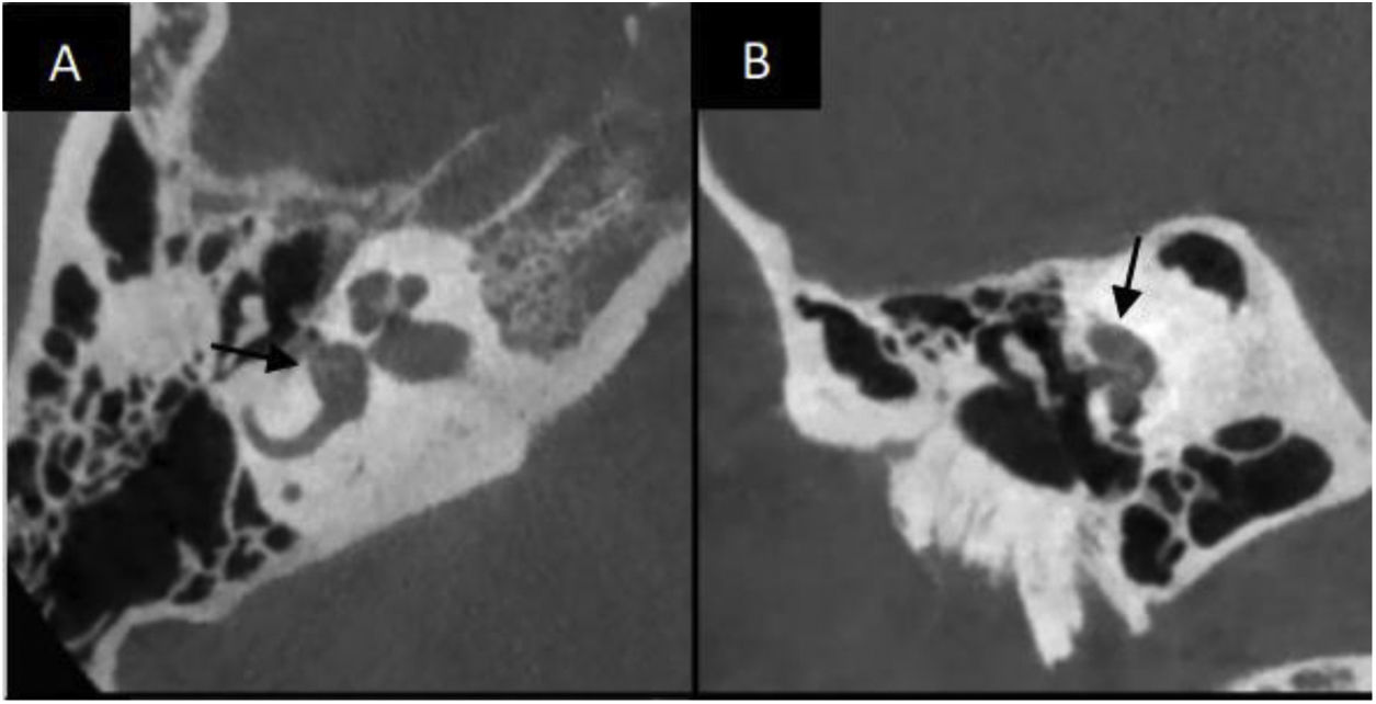 Post-stapedectomy intravestibular luxation of the stapes | Acta ...
