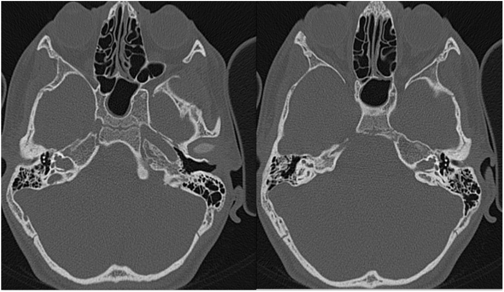 Cochlear implantation in incomplete partition type III | Acta ...