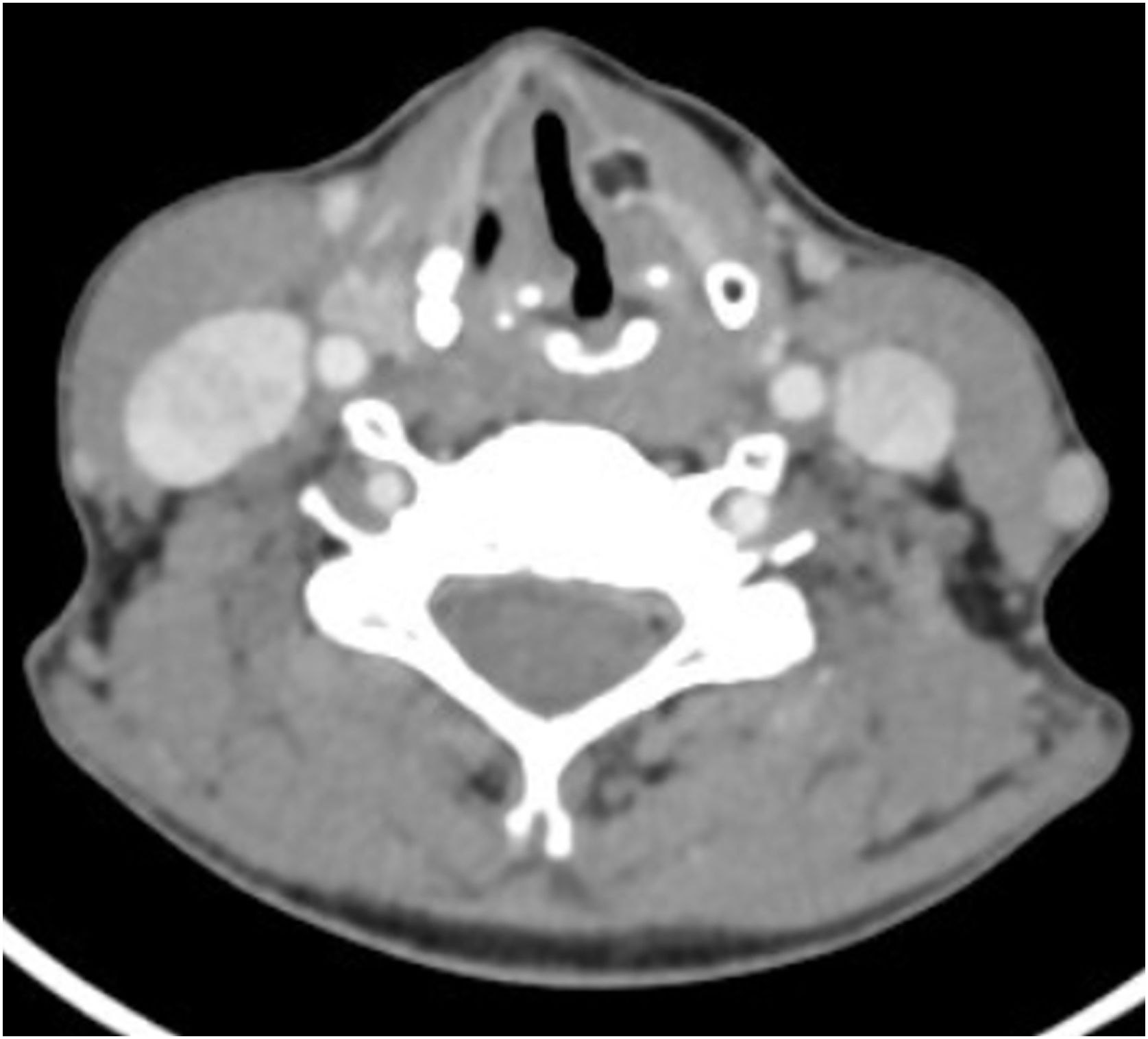 Thyroid chondroma, a case report | Acta Otorrinolaringológica Española