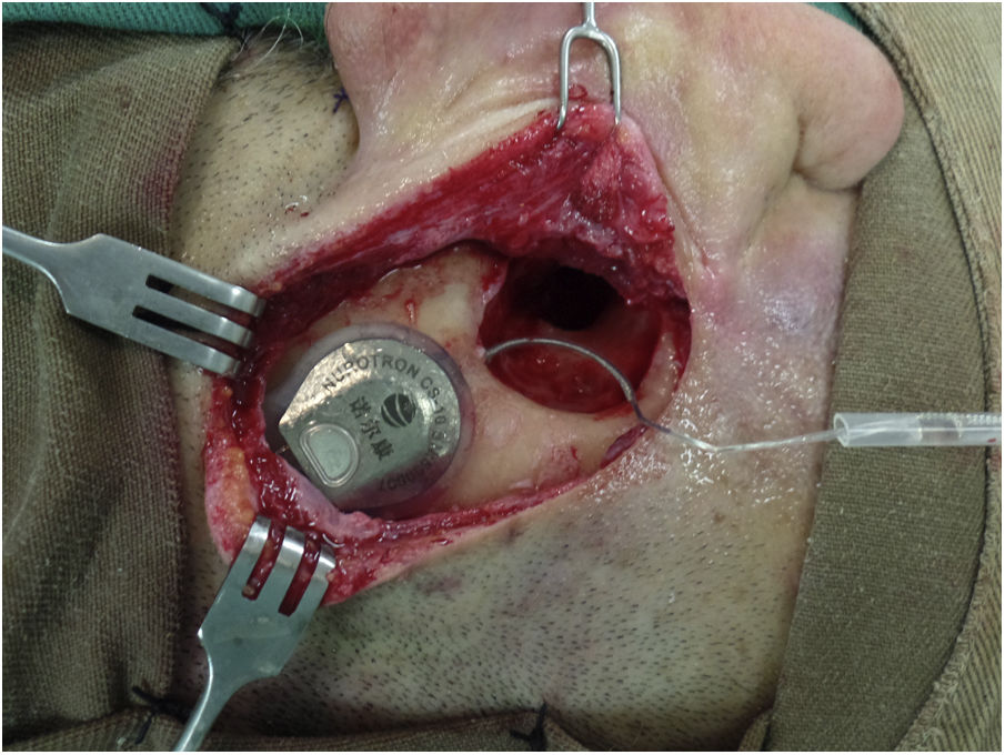 cochlear implant surgery