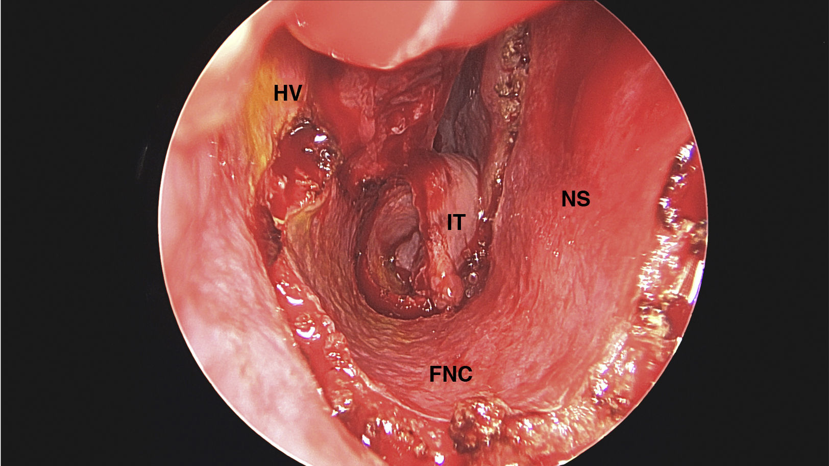 Section and repositioning of the inferior turbinate in the design of ...