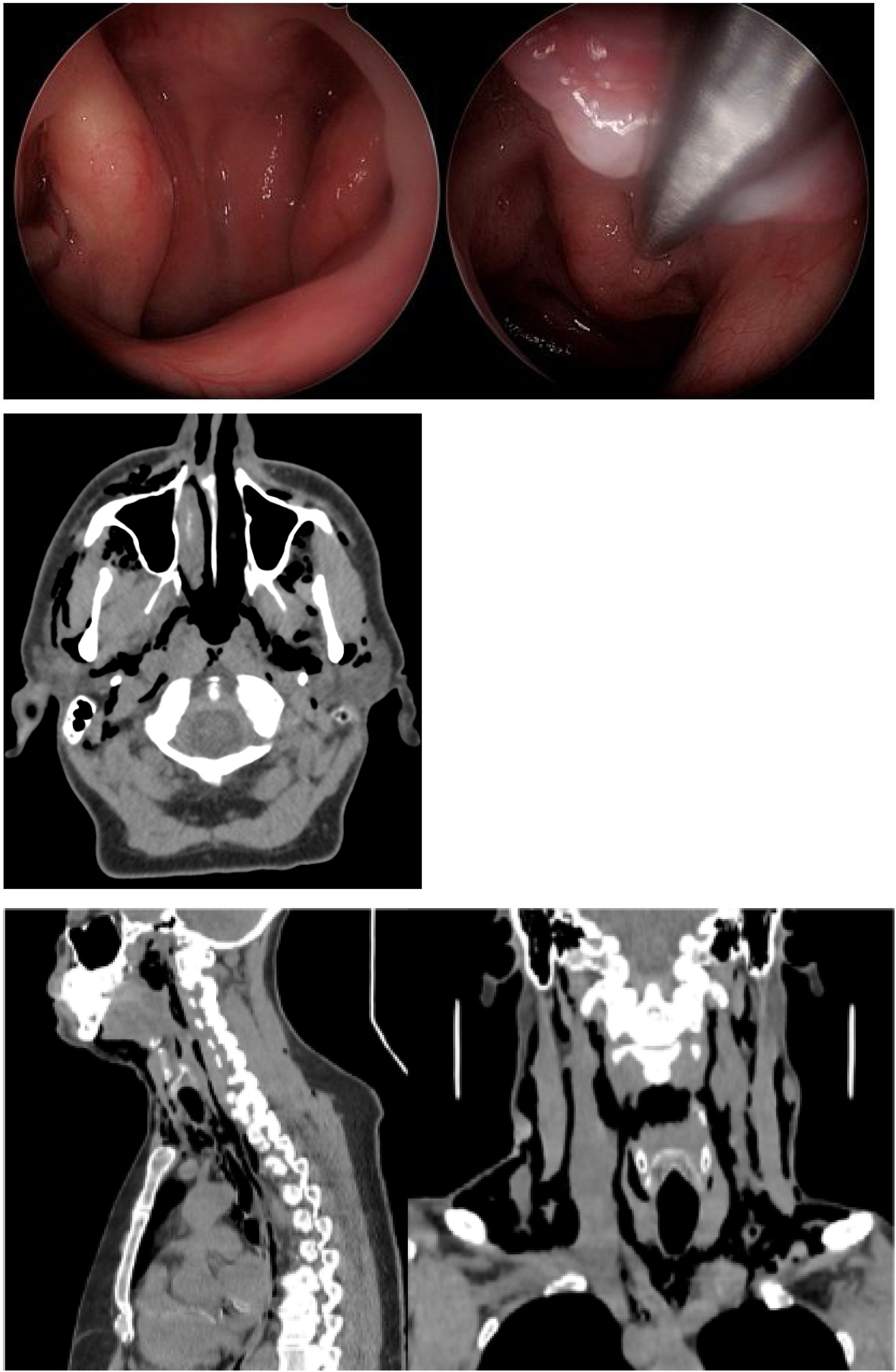 Subcutaneous emphysema secondary to Eustachian tube dilation | Acta ...