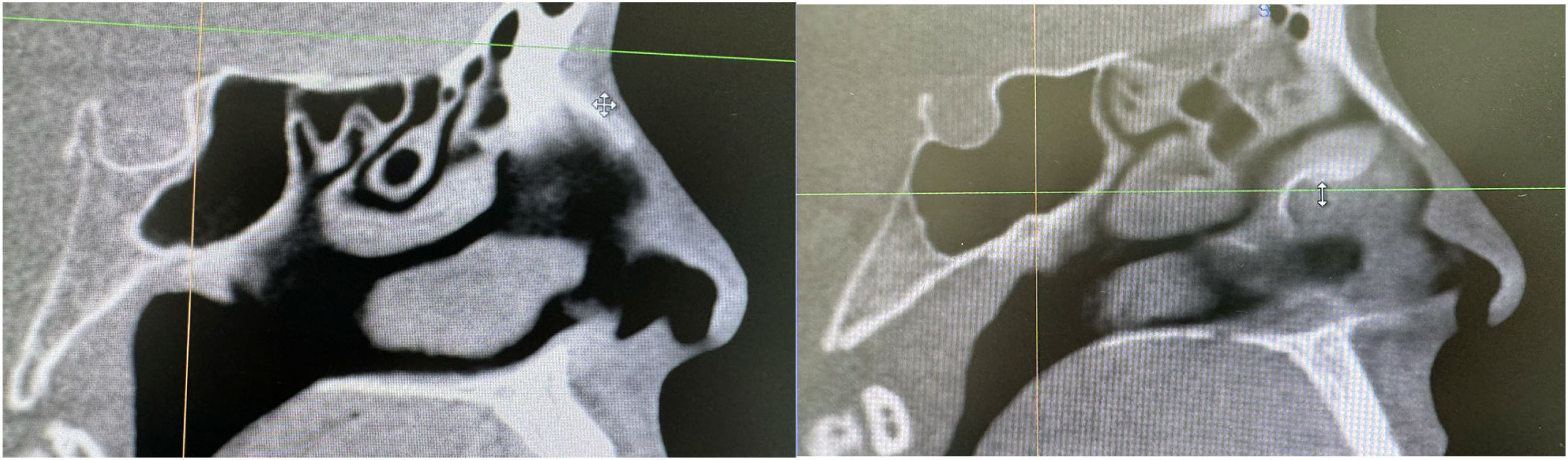 Anatomical variations of sphenoid sinus on cone beam computed ...