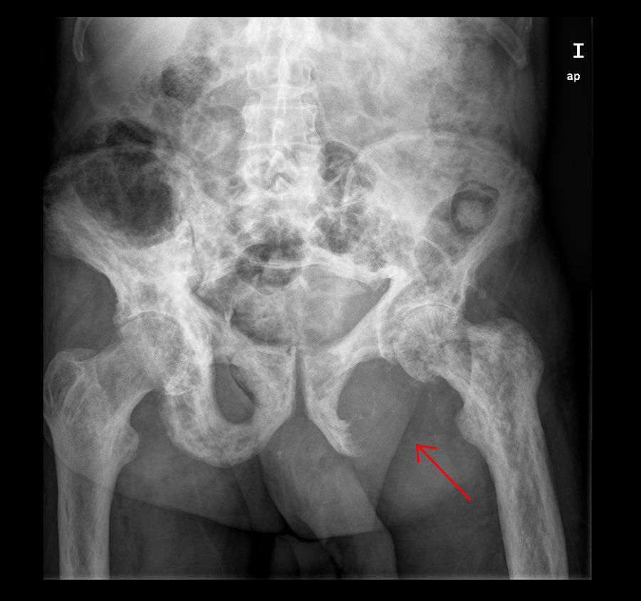 Ischiopubic Pain in a Patient with Paget's Disease | Reumatología Clínica