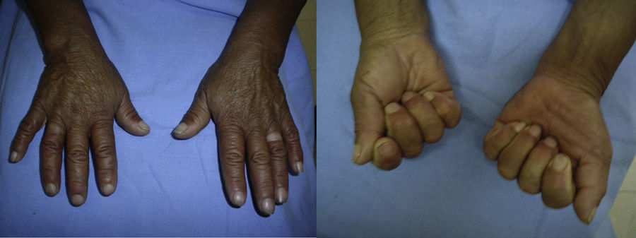 pitting edema hands