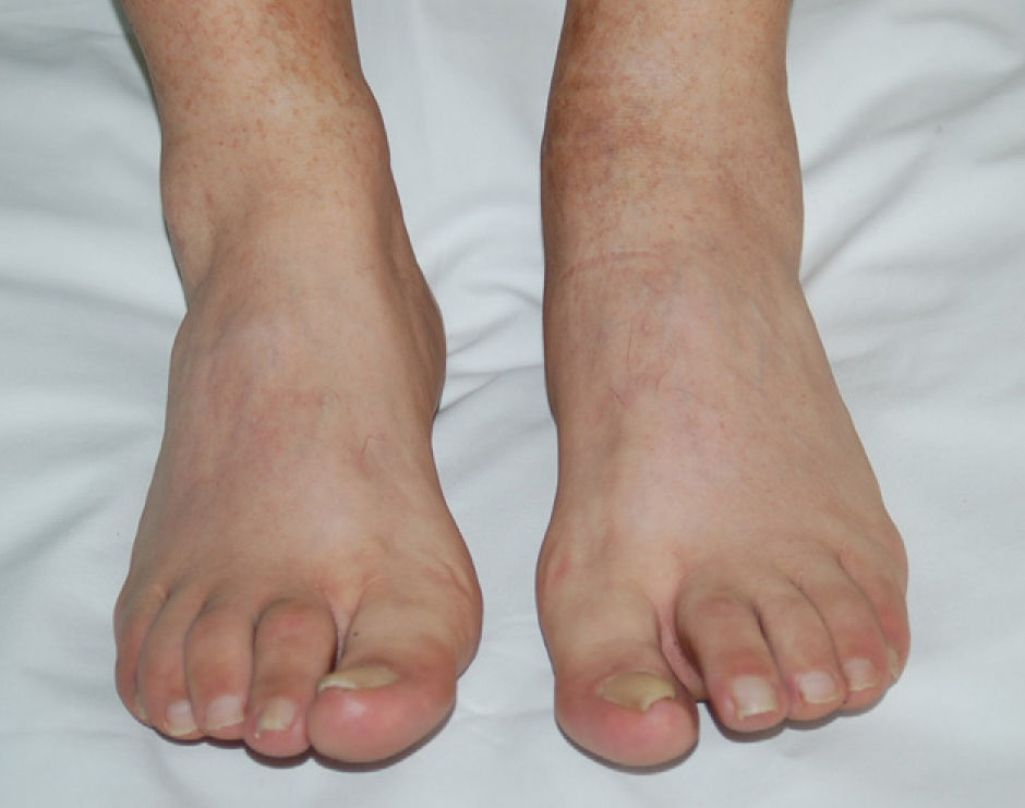 Reactive Arthritis After the Intravesical Instillation of BCG