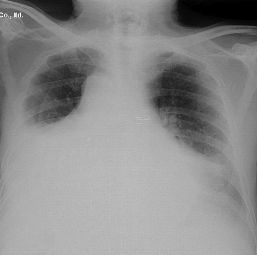 bilateral pleural effusion