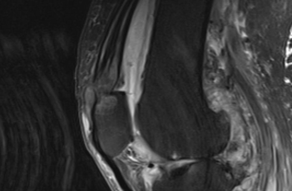 Septic Arthritis Associated to Gout and Pseudogout: The Importance of ...