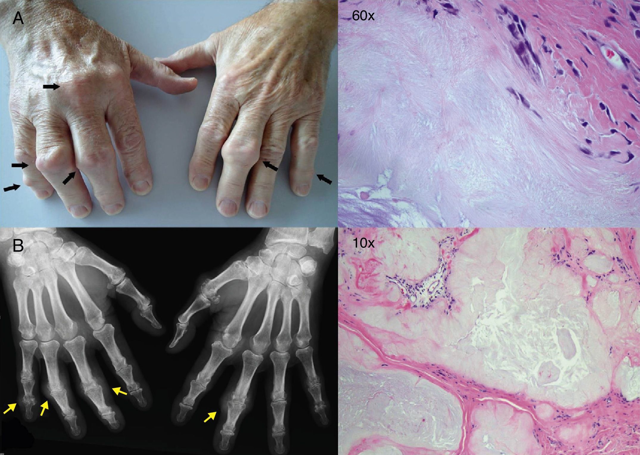 Periarticular Nodules, Arthritis and Chronic Nephropathy | Reumatología ...