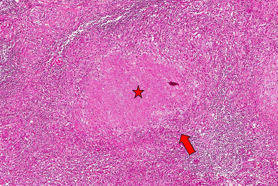 Pott's Disease: An Uncommon Cause of Thoracolumbar Pain Nowadays ...