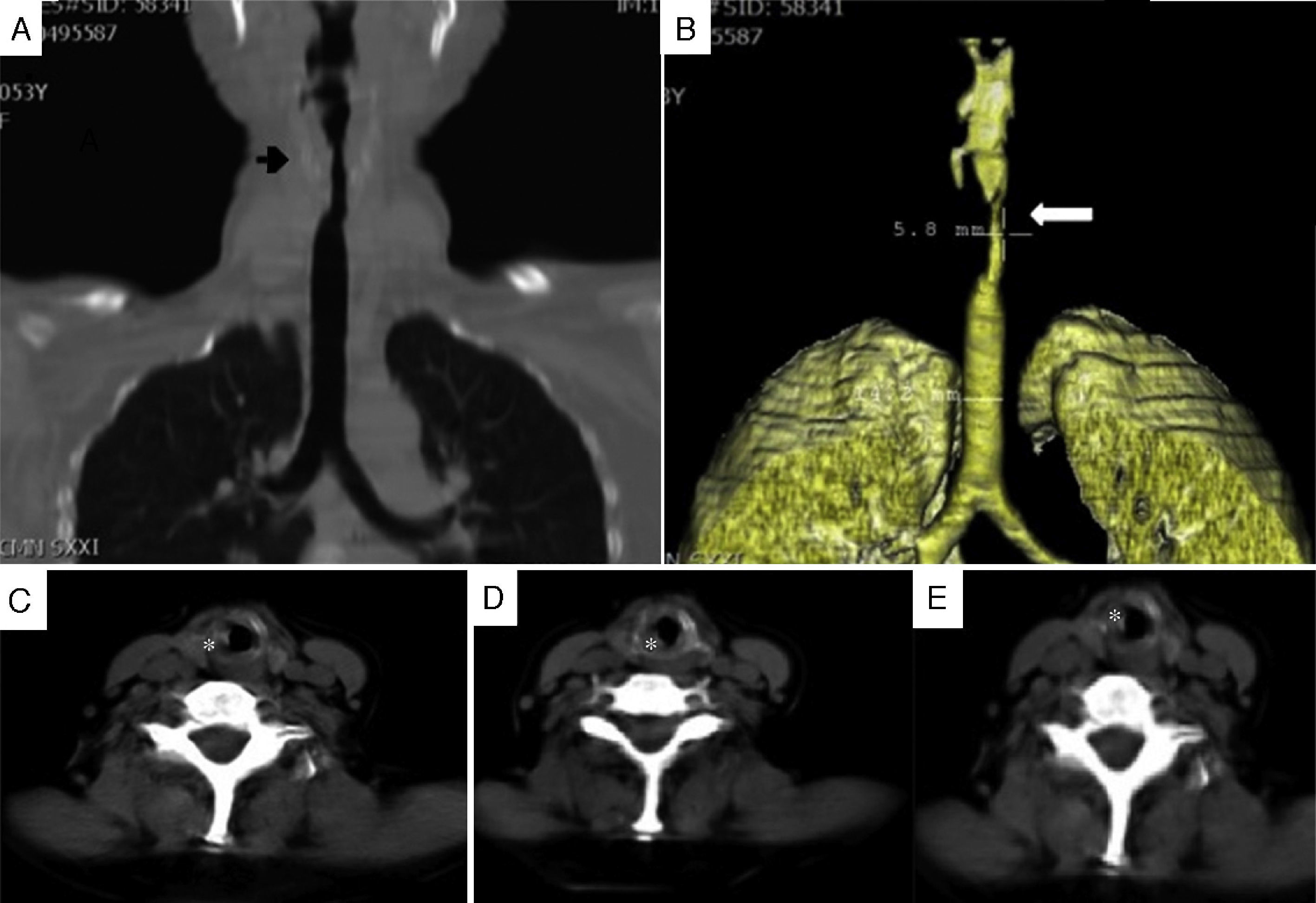 subglottic stenosis grading
