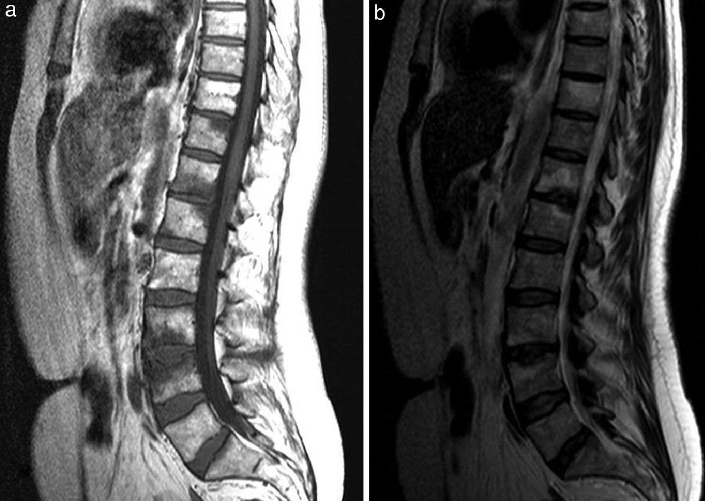 SAPHO Syndrome Presenting as an Osteolytic Lesion of the Neck ...