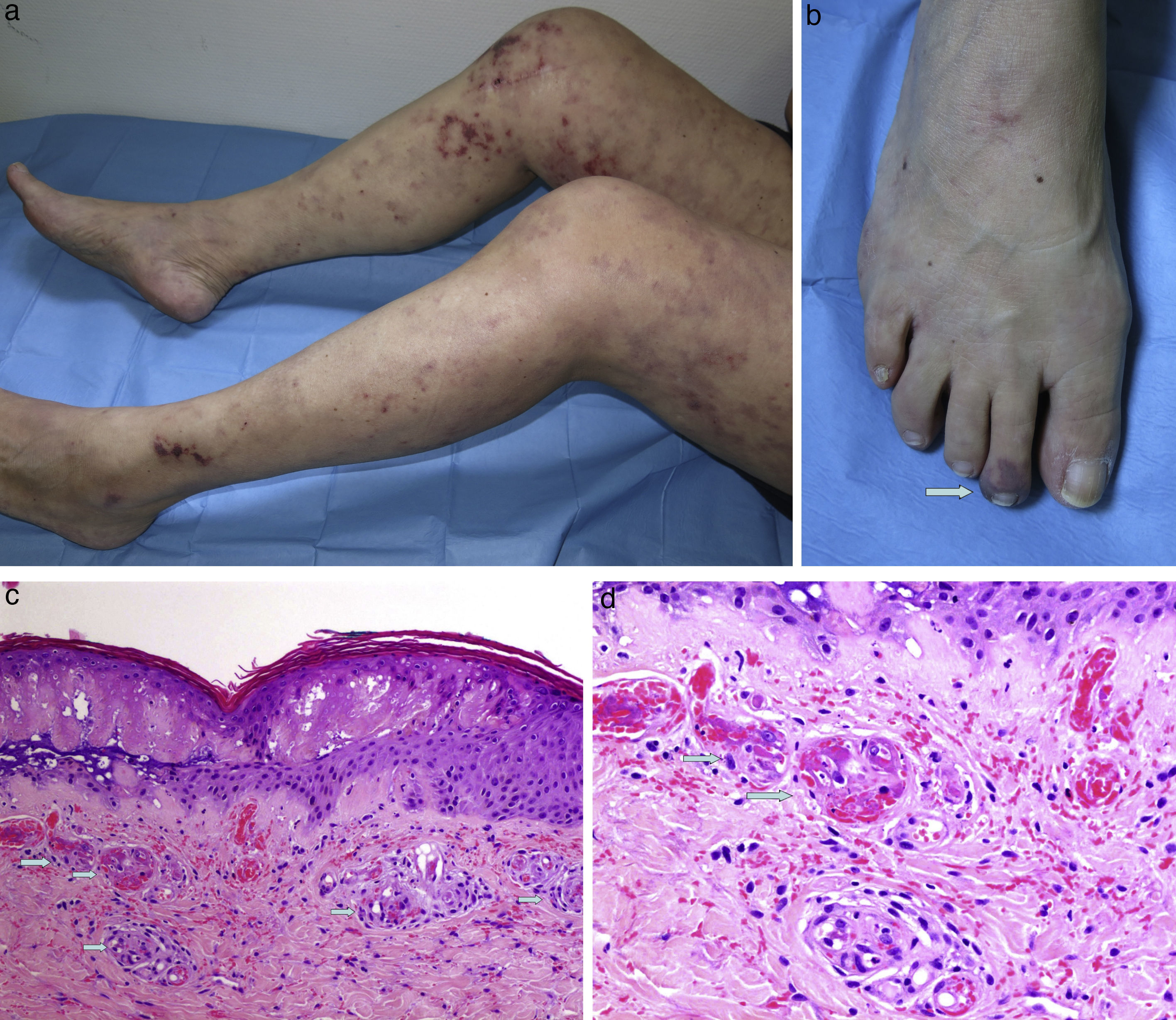 hyperphosphatemia skin