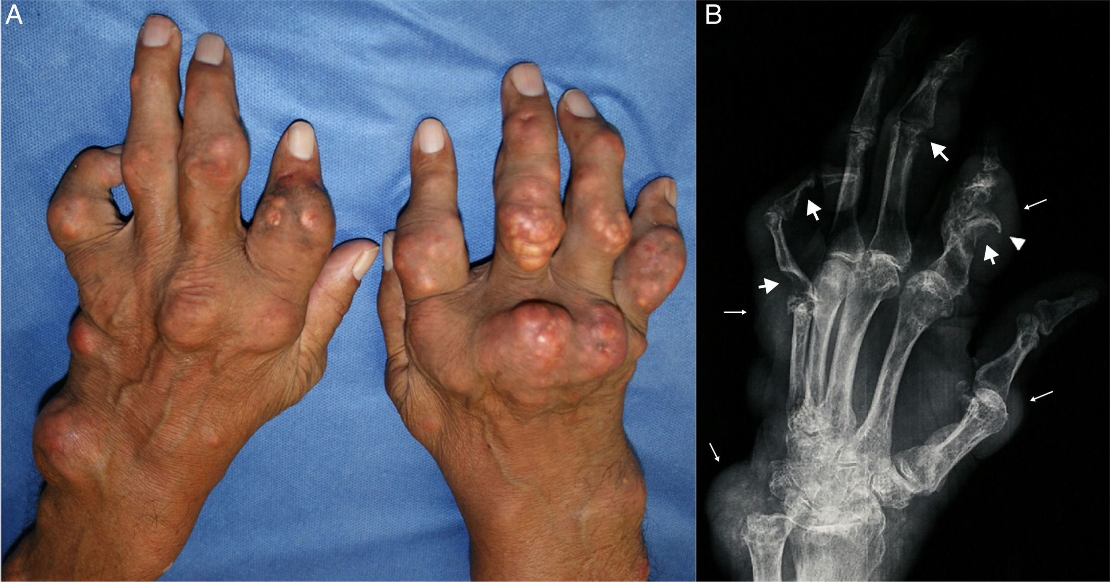 gout xray changes