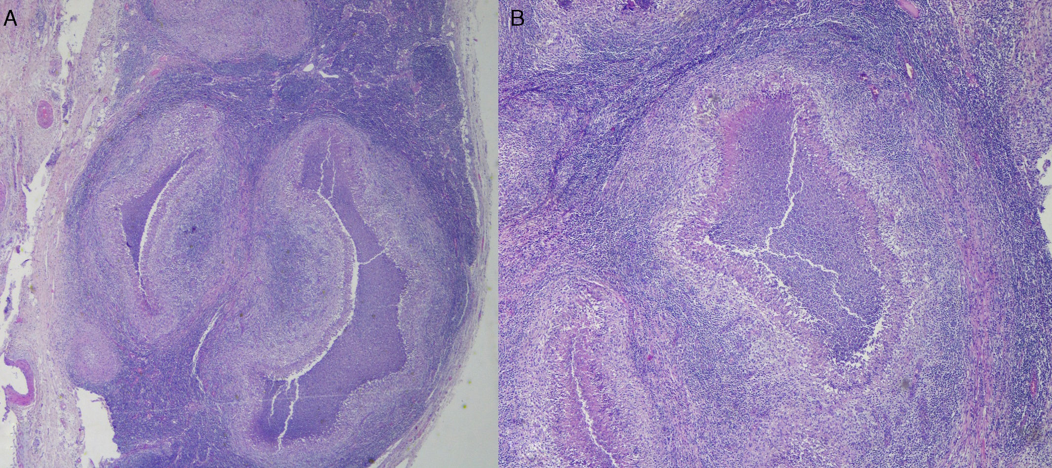 Cat Scratch Disease During Etanercept Therapy in a Rheumatoid Arthritis ...