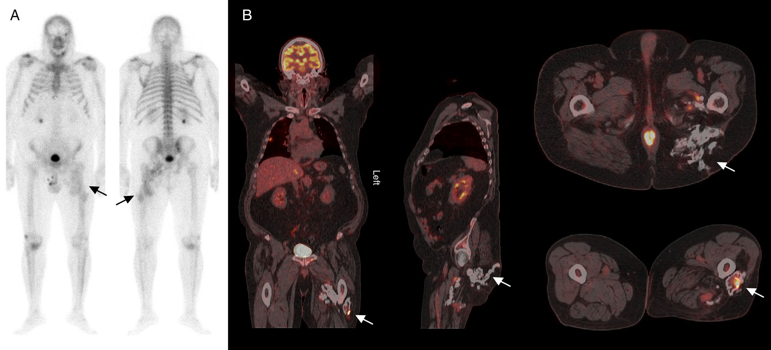 Imaging in Myositis Ossificans: Bone Scintigraphy and 18F ...