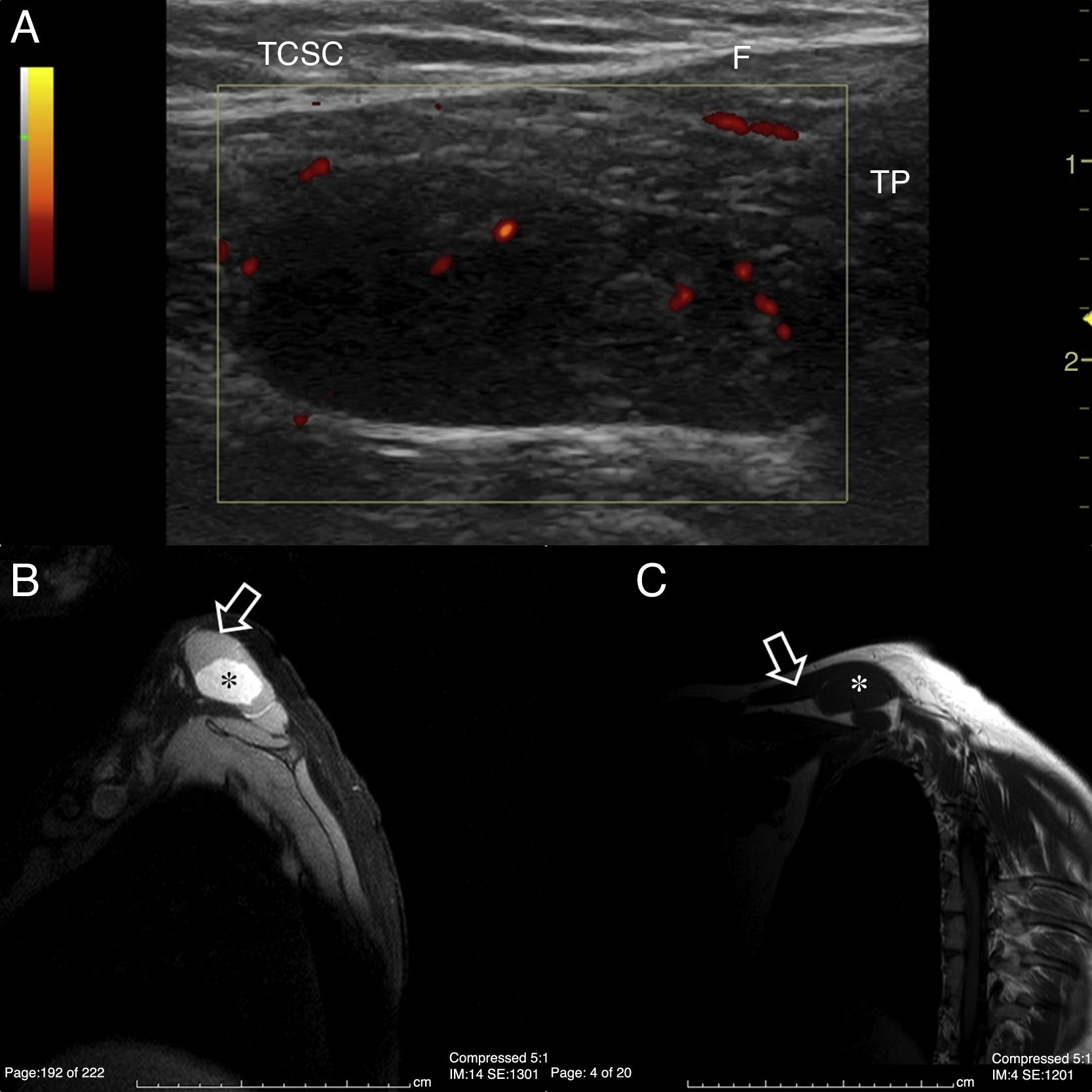 Myofibroblastic Sarcoma of the Trapezius Muscle | Reumatología Clínica
