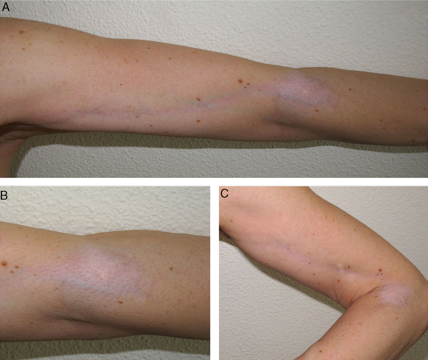 Linear atrophy and hypopigmentation after intralesional corticosteroid ...