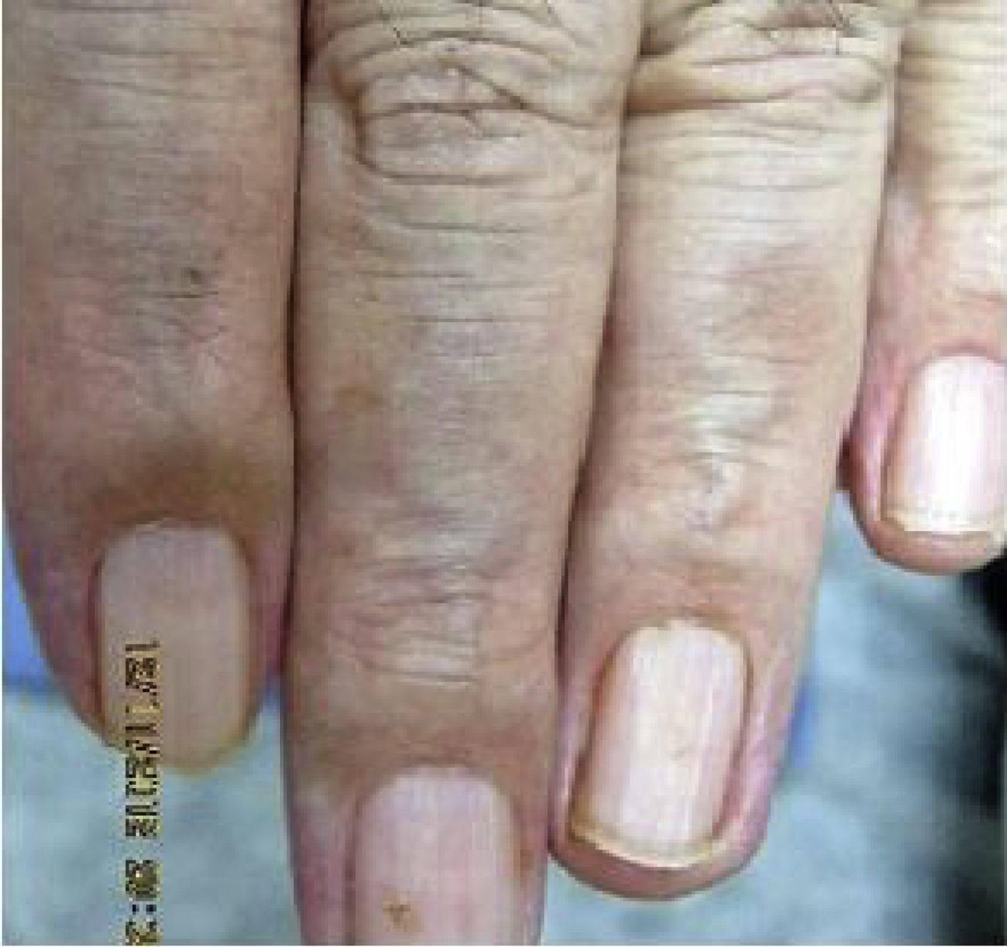 microscopic polyangiitis neuropathy