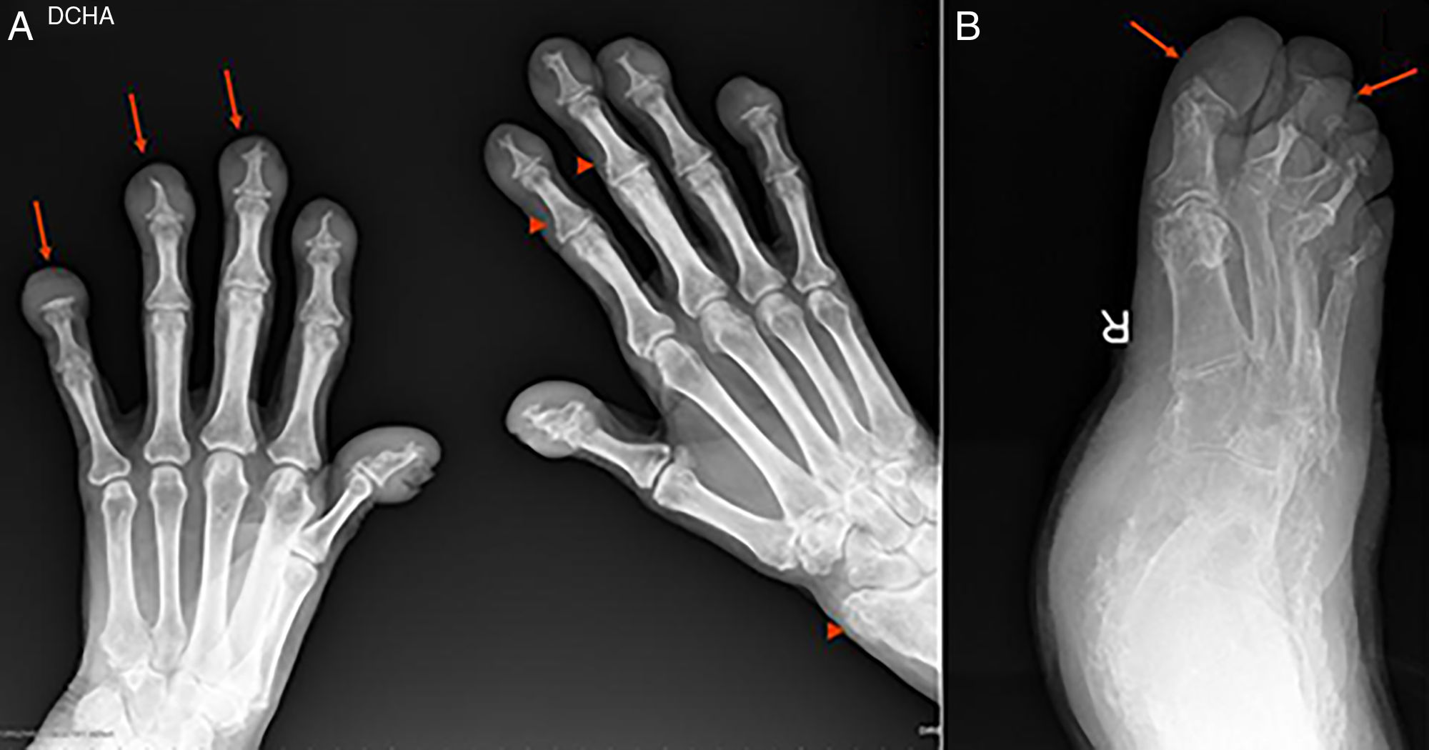 Digital Clubbing: A Patient With Hypertrophic Osteoarthropathy and the ...
