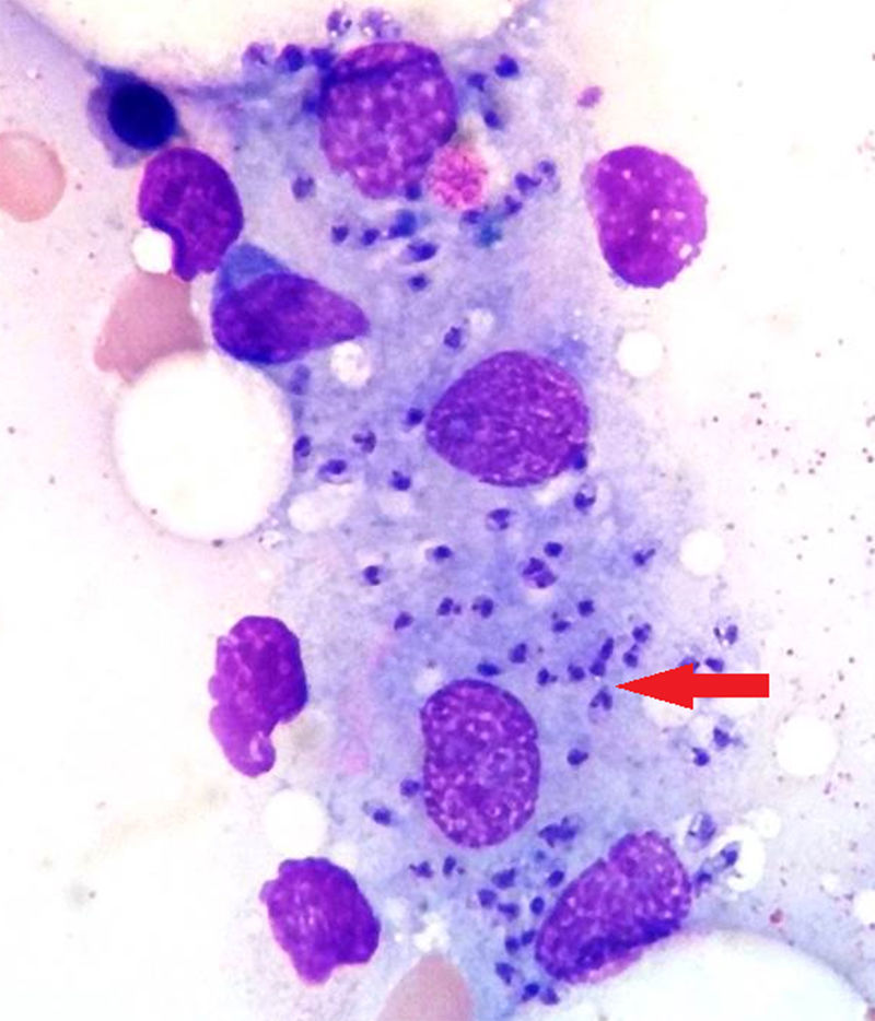 leishmania bone marrow