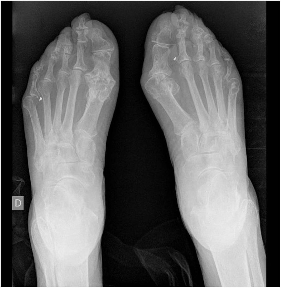 Tophaceous gout in a woman | Reumatología Clínica