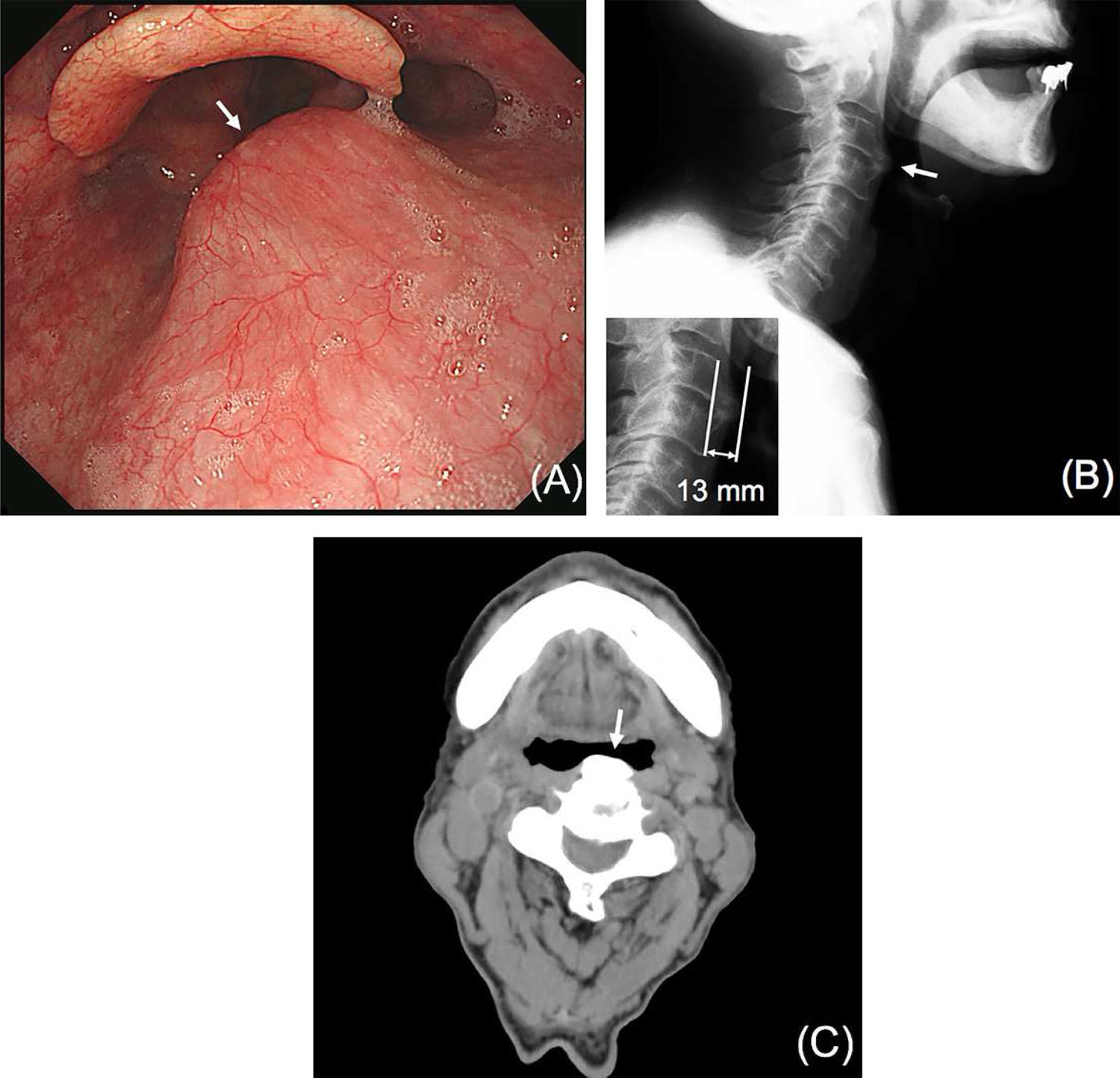 Hypertrophic anterior cervical osteophyte | Reumatología Clínica