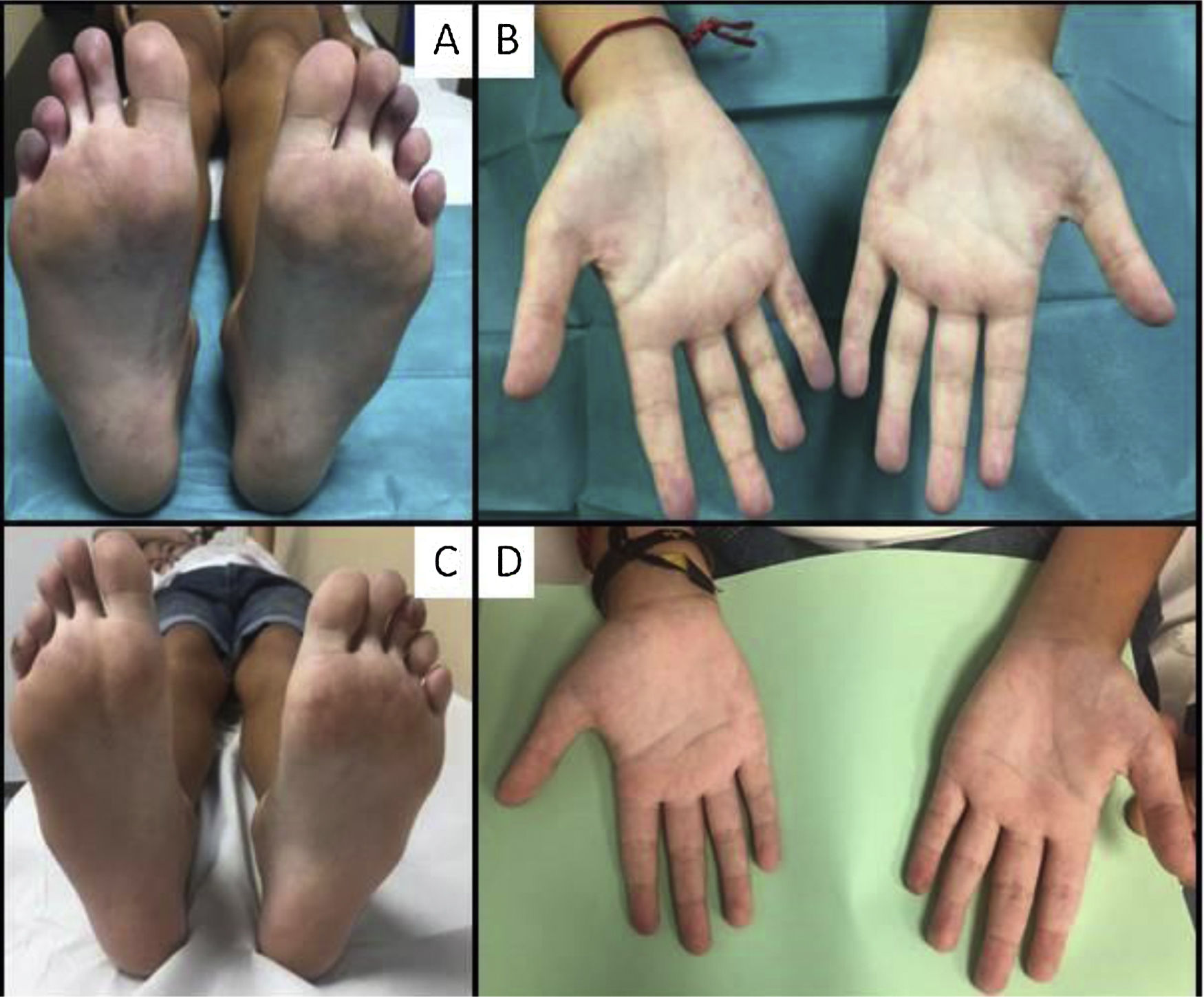 Digital ischemia as the initial presentation of catastrophic ...