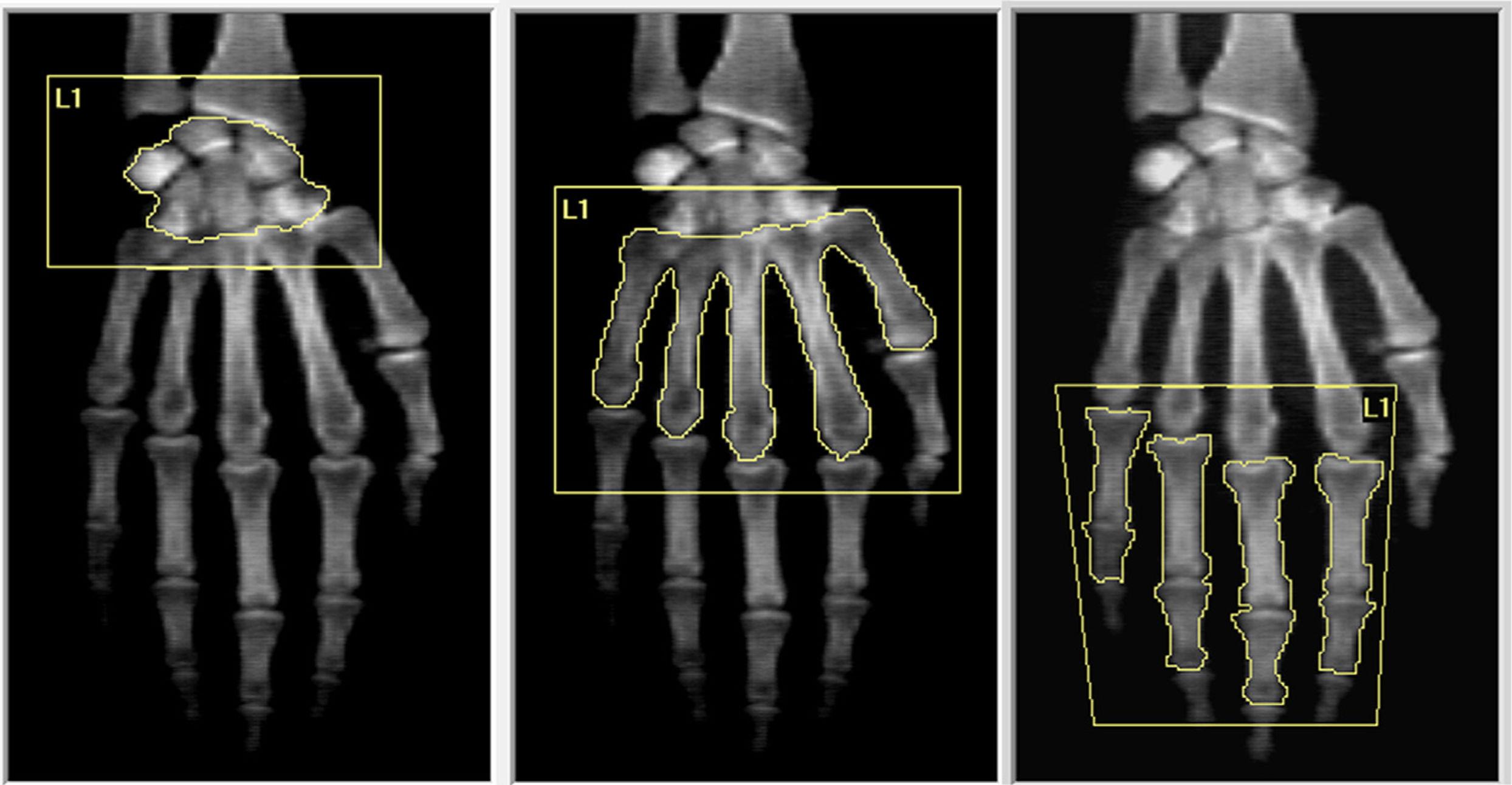 Whole-hand and regional bone mineral density involvement in rheumatoid ...