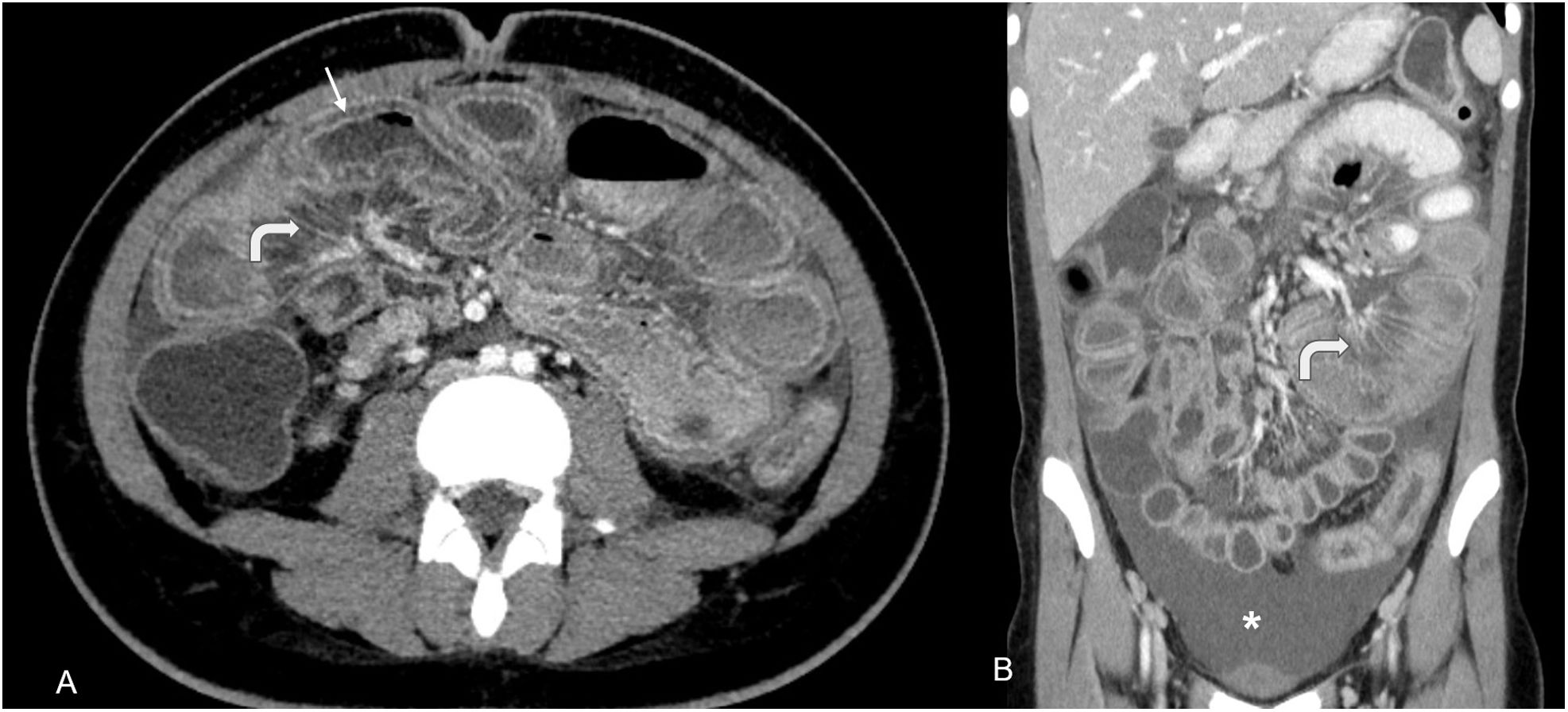 The “target sign”: A hallmark of lupus enteritis | Reumatología Clínica