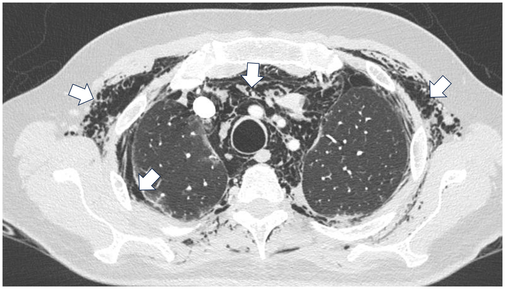 Spontaneous pneumomediastinum: An extra muscular manifestation of anti ...