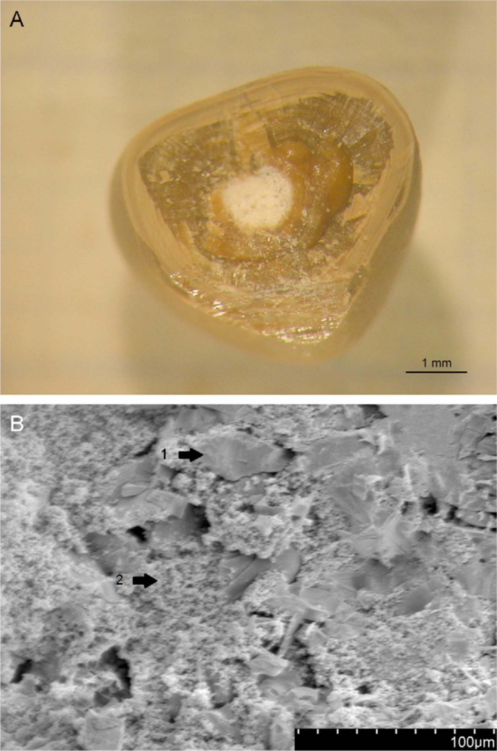 Rare kidney stones | Actas Urológicas Españolas (English Edition)