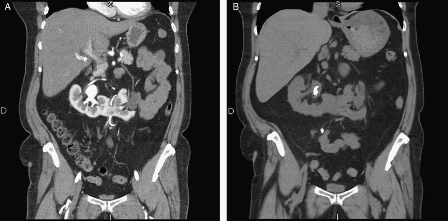 Surgical therapy of lithiasis in horseshoe kidney | Actas Urológicas ...